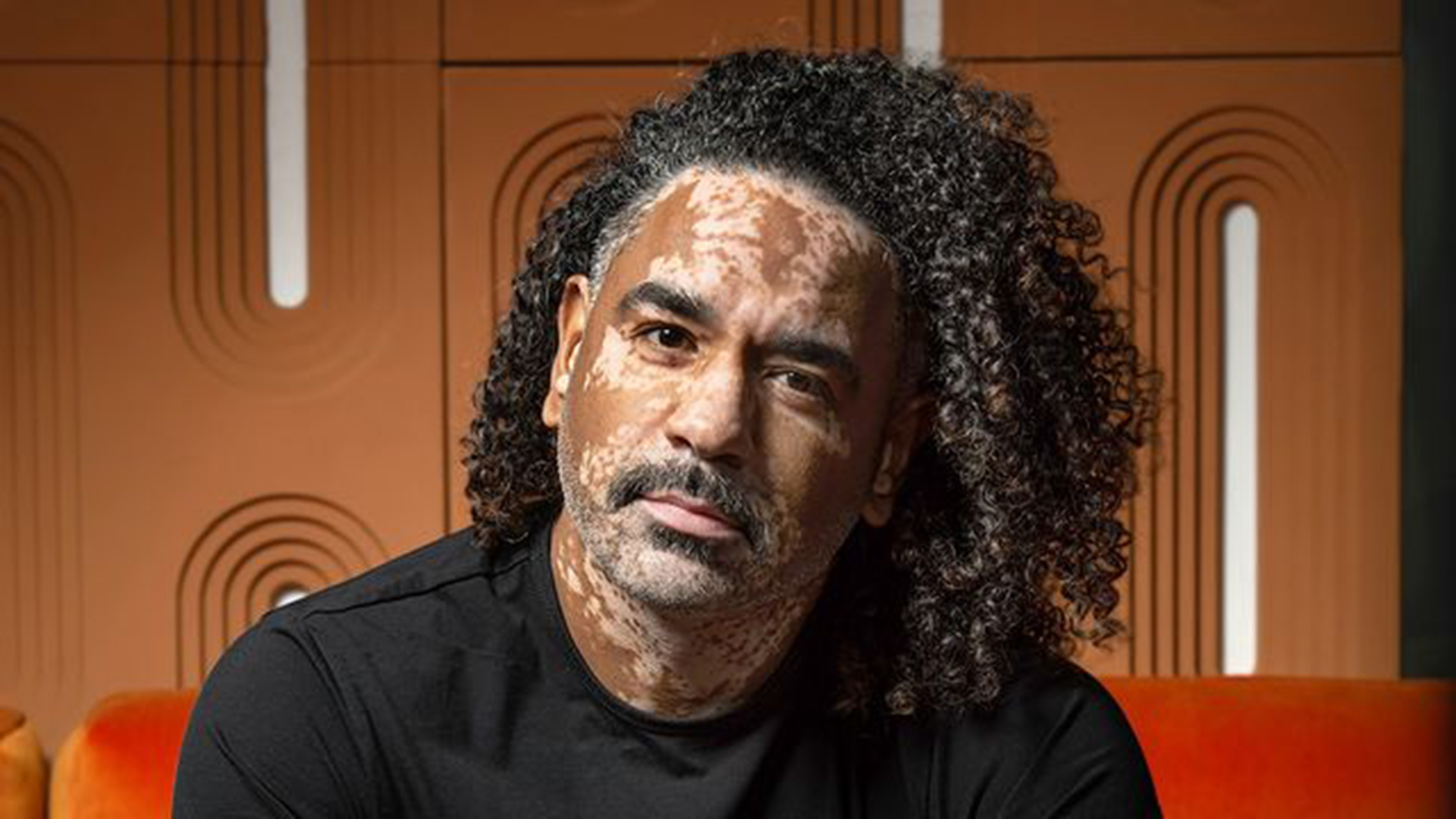 B.C. man starts Canada's first vitiligo support group - Polite Canada